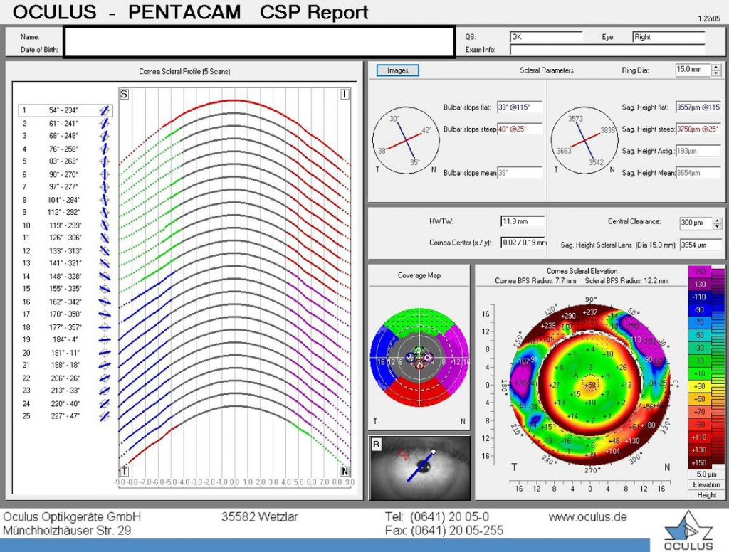 Improving Comfort of Scleral Lenses with Onefit™ MED - Linh Chieu, OD ...