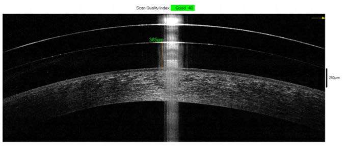 Onefit Spotlight Case Report: Custom Onefit™ MED with Toric Haptic ...