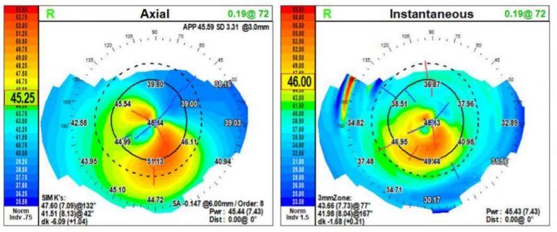 Onefit Spotlight Case Report: Custom Onefit™ MED with Toric Haptic ...